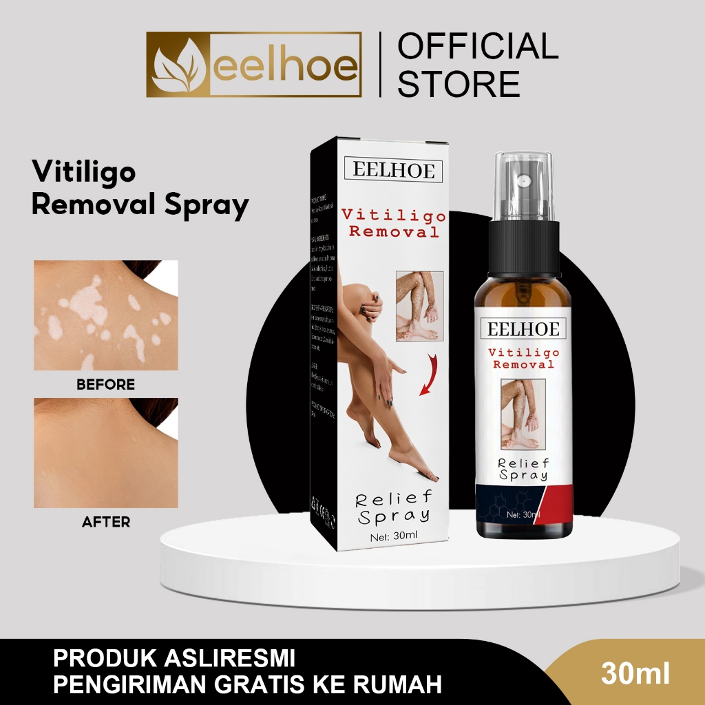 Jual EELHOE Vitiligo Removal Spray 30ml Salep Vitiligo Krim Vitiligo ...