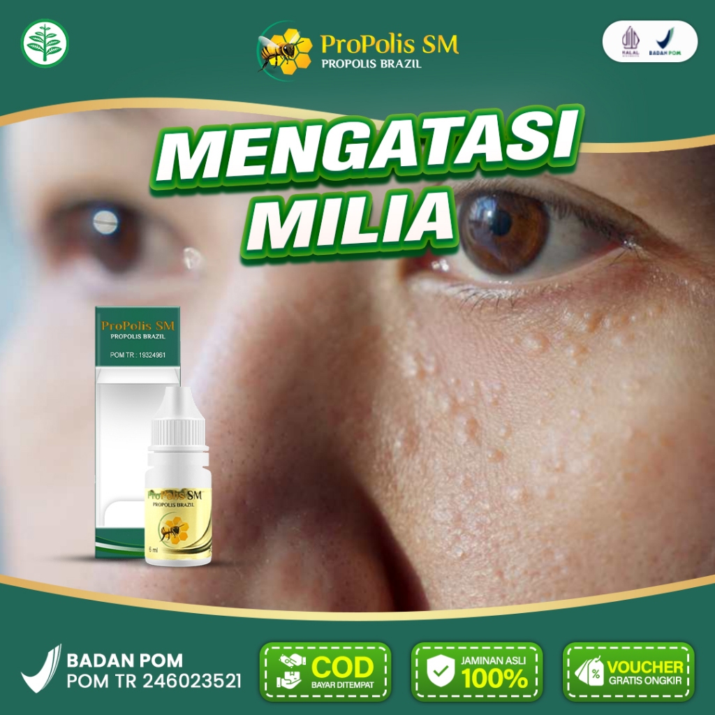 Jual Propolis SM Obat Oles Milia Di Bawah Mata Kelopak Mata Bintik ...