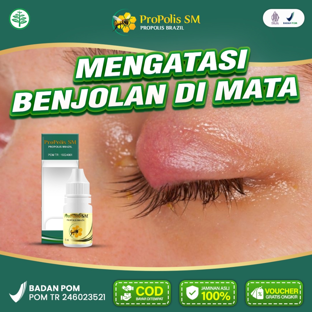 Jual Propolis SM Obat Benjolan Di Kelopak Mata Bintitan Bintilan ...
