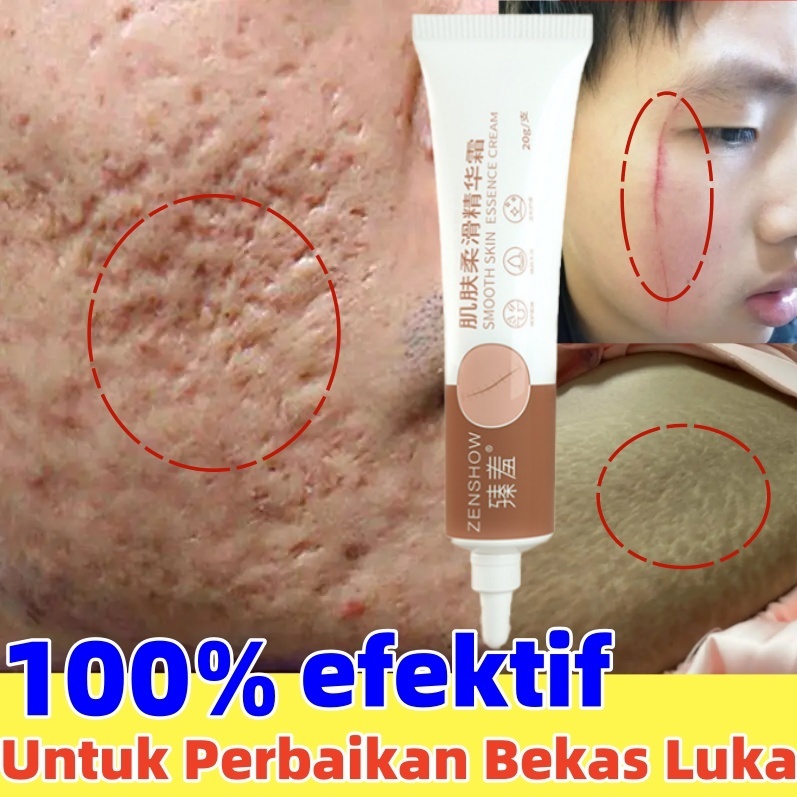 Jual penghilang bekas luka menghilangkan bekas luka penghilang bekas ...
