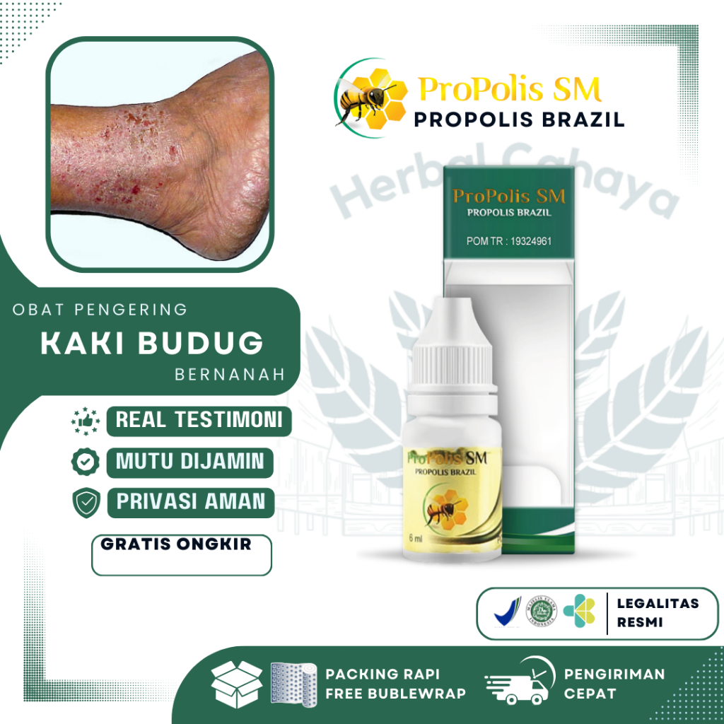 Jual Salep Penghilang Bekas Budug Borok Kurap Kudis Kurap Eksim Scabies ...