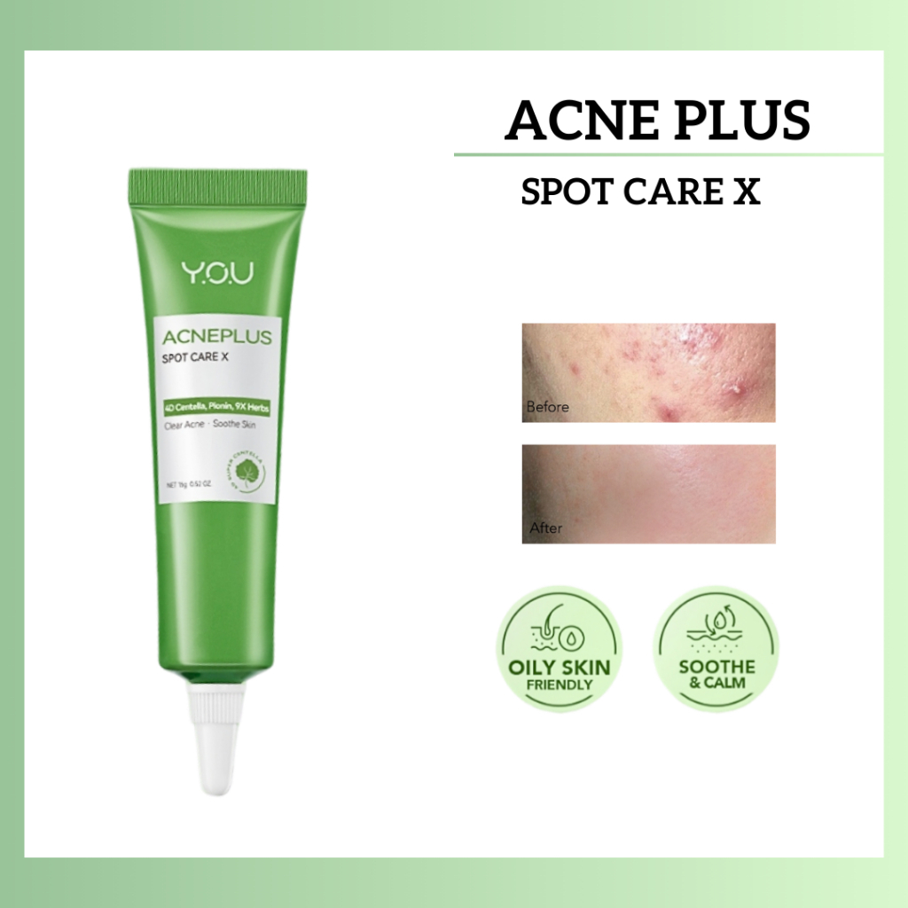 Jual You Acne Plus Triple Action Spot Care X 15g | Shopee Indonesia