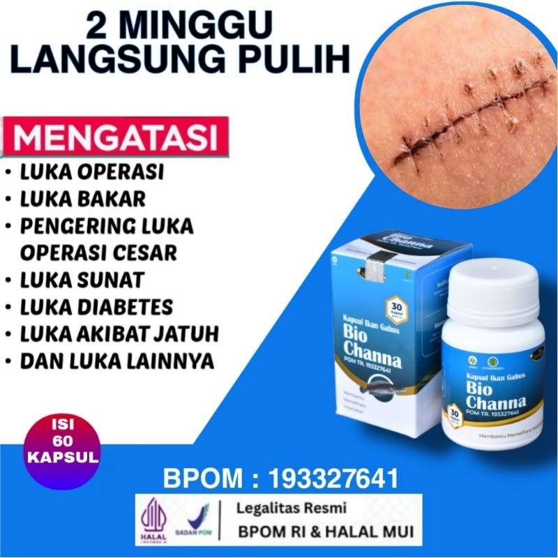 Jual Kapsul Ikan Gabus Obat Luka Pasca Operasi Albumin Sari Kutuk 3-7 Hari Langsung Kering ...
