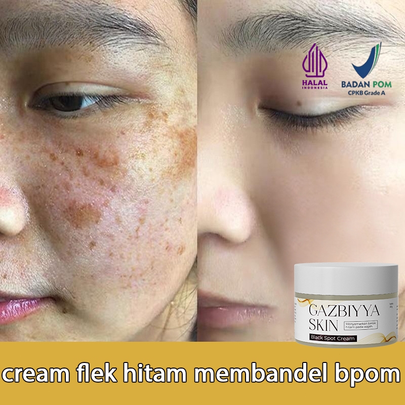Jual 【BPOM】Krim penghilang flek hitam cream flek hitam membandel salep ...