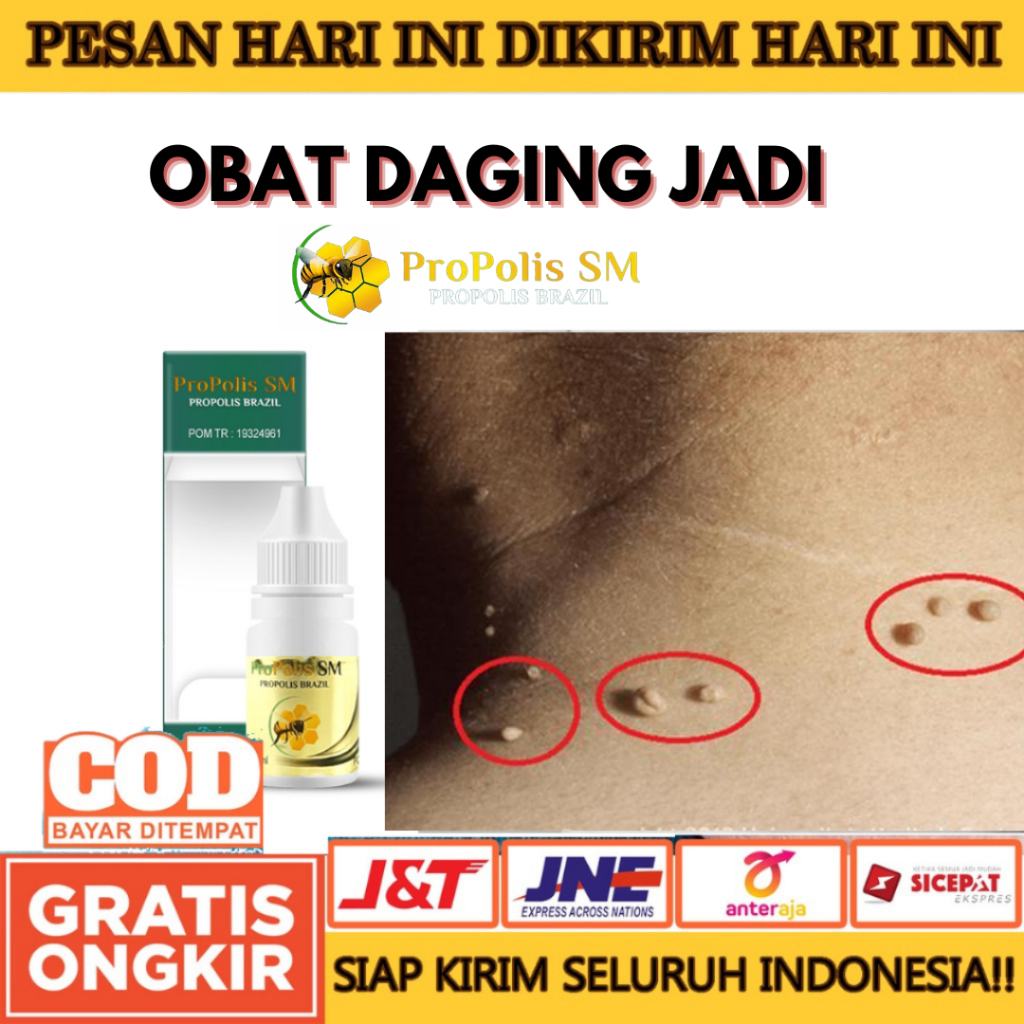 Jual Obat Daging Jadi, Keloid Menahun,keloid, Daging Tumbuh Luka Tindik Bekas Operasi Caesar ...
