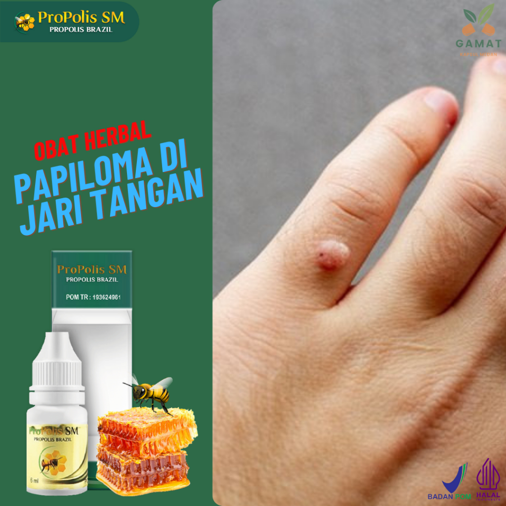 Jual Obat Papiloma di Jari Tangan Kaki - Obat Papiloma di Wajah ...