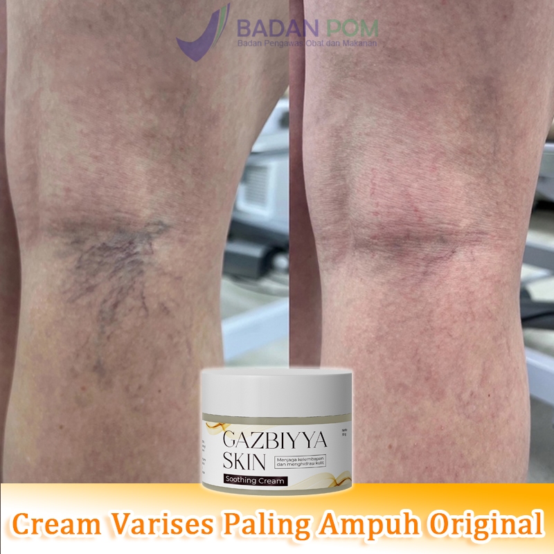 Jual Cream varises paling ampuh original salep varises obat varises ...