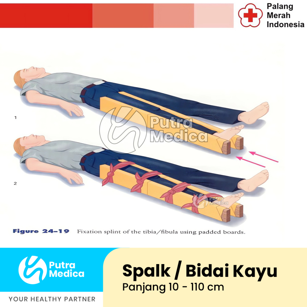 Jual Spalk Bidai Kayu Spons 50cm x 10cm x 8mm - 1pc / Gips Patah Tulang ...