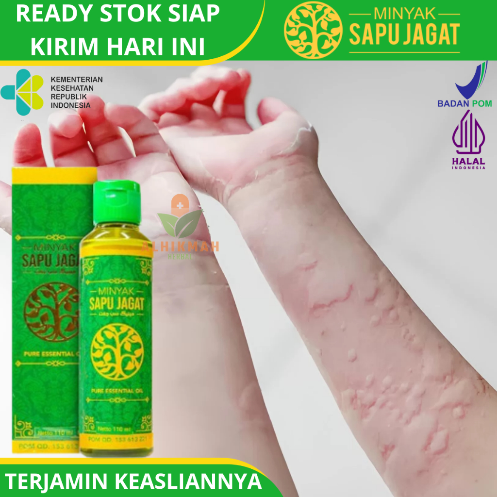 Jual Minyak Oles Kulit Gatal Alergi Biduran Kaligata, Obat Alergi ...