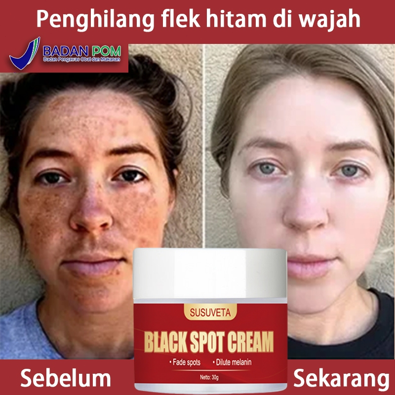 Jual Penghilang flek hitam membandel flek hitam di wajah membandel ...