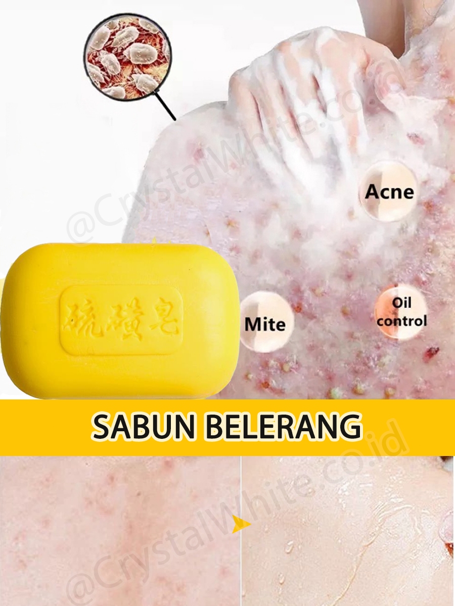 Jual Sabun Cair Jerawat Punggung Sabun Gatal Gatal Paling Ampuh 100% ...
