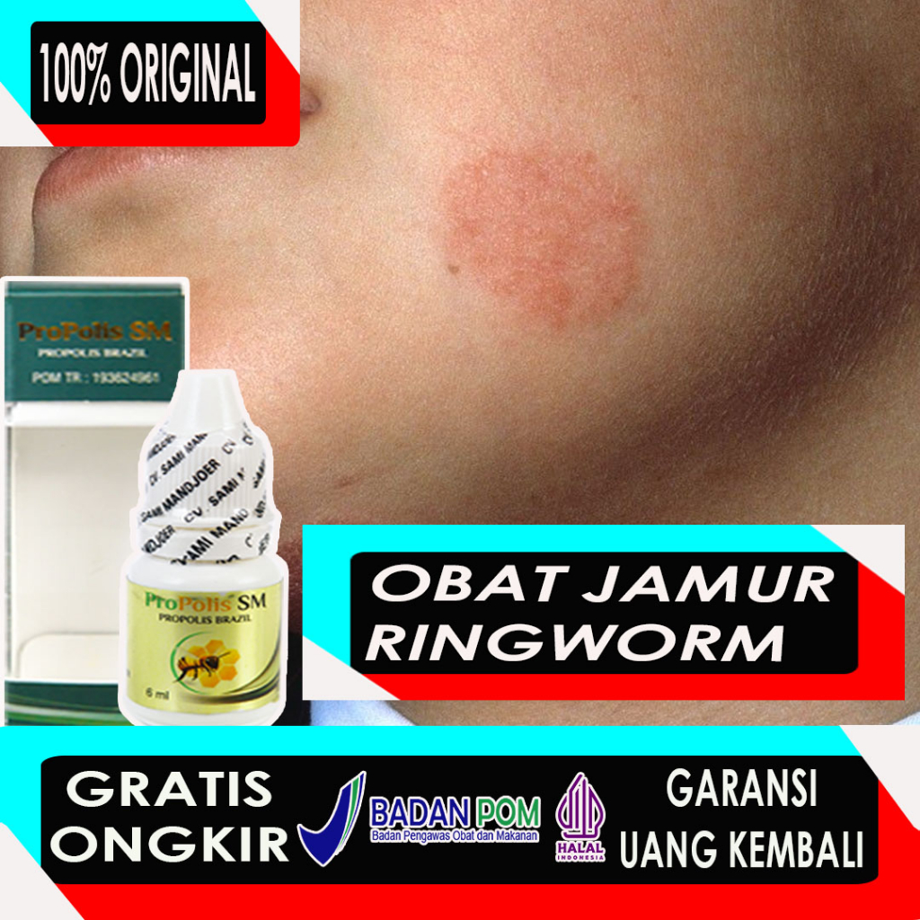 Jual Propolis Sm - Obat Ringworm Pada Manusia - Jamur Kulit - Obat ...