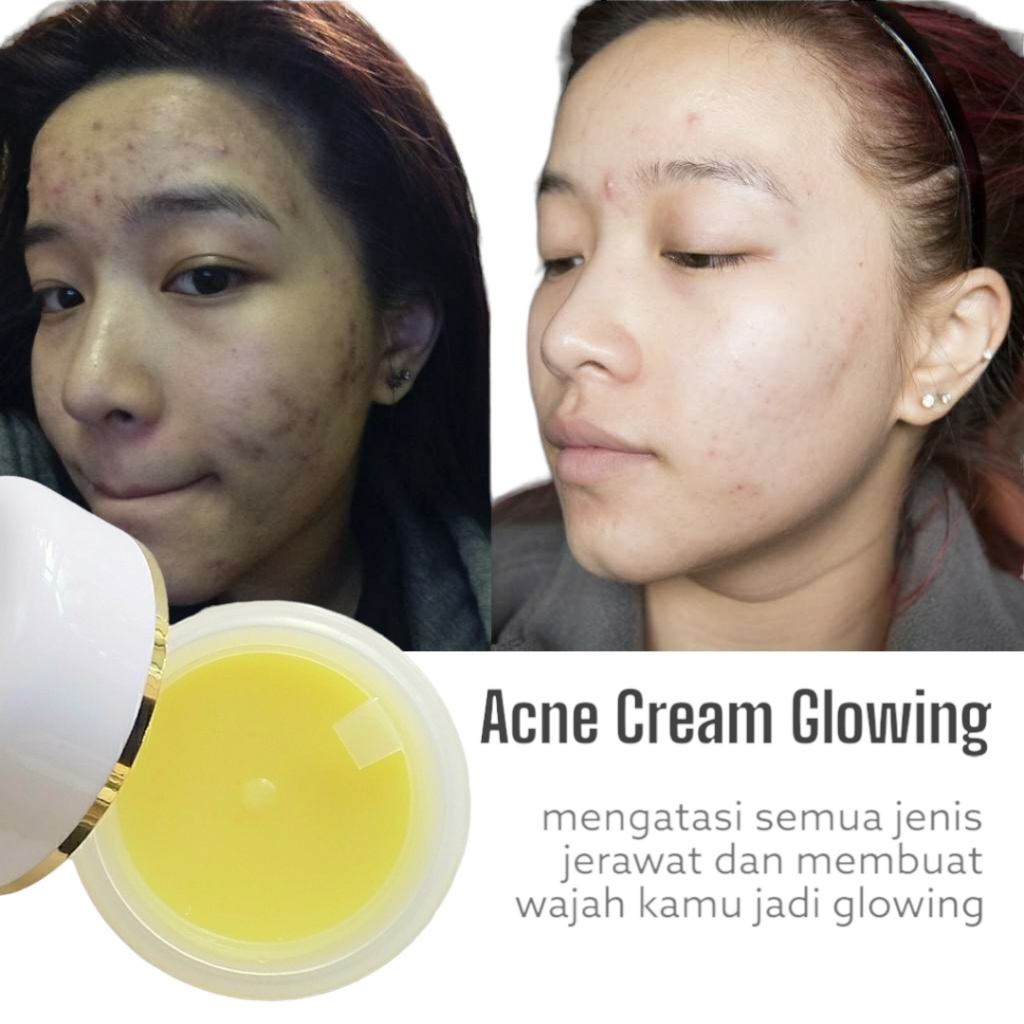 Jual ACNE CREAM MALAM GLOWING KRIM JERAWAT UNTUK KULIT BERJERAWAT ...