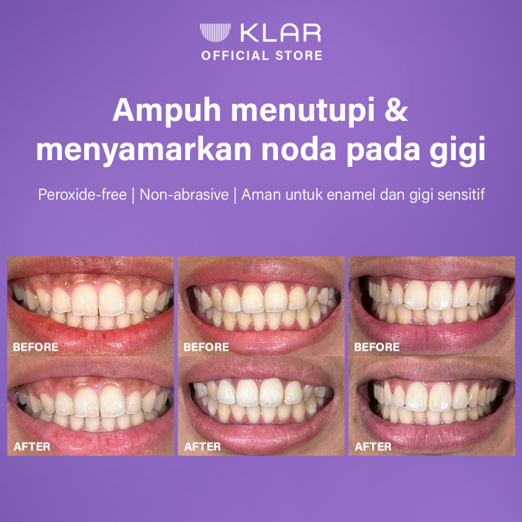 Jual KLAR Purple Teeth Whitening Booster | Pemutih gigi instant 2 menit ...