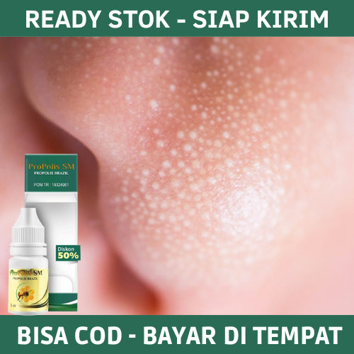 Jual Obat Tetes Milia Di Wajah, Obat Milia Di Bawah Kelopak Mata, Obat ...