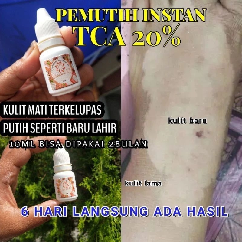 Jual PEELING TCA EKSFOLIASI 20 %. KUSUS KULIT HITAM DAKI LAKNAT ...