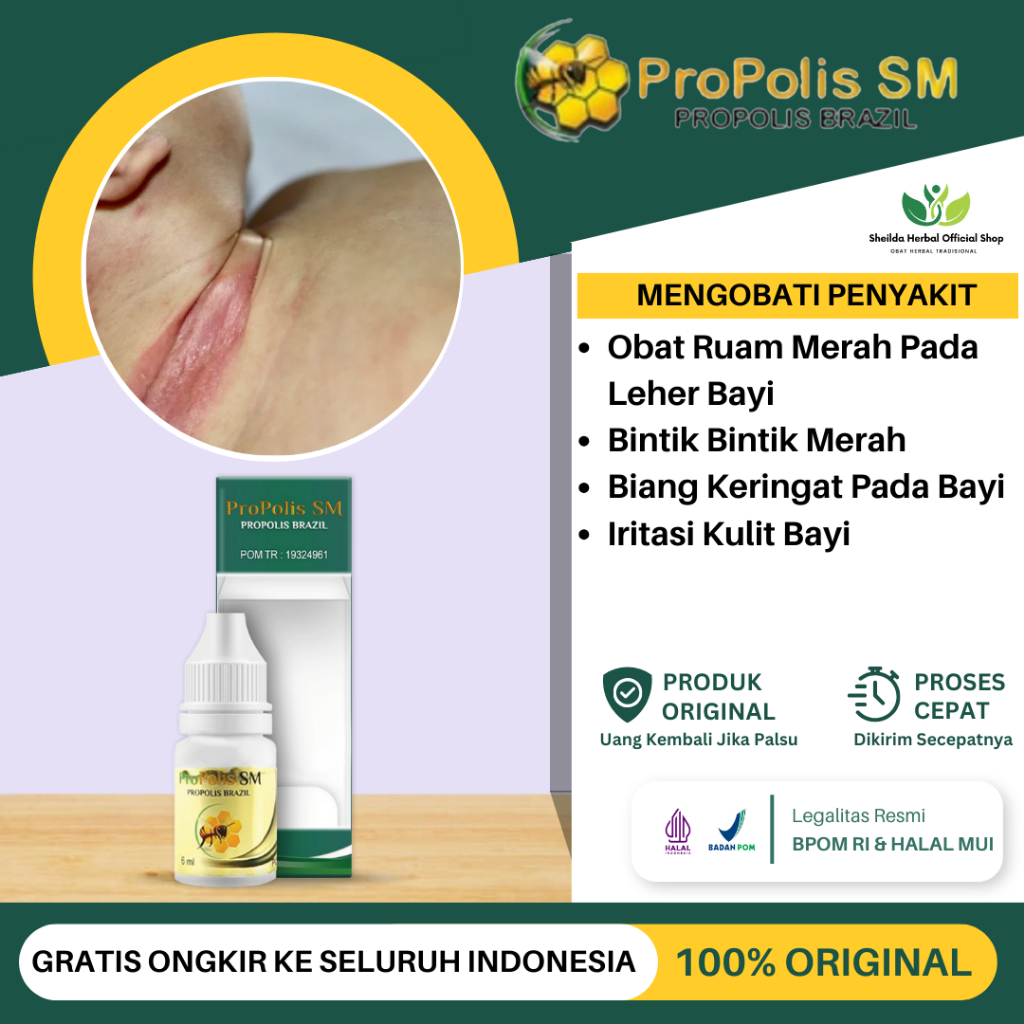 Jual Obat Untuk Ruam Merah Pada Leher Bayi, Ruam Lecet Berair Pada Anak ...