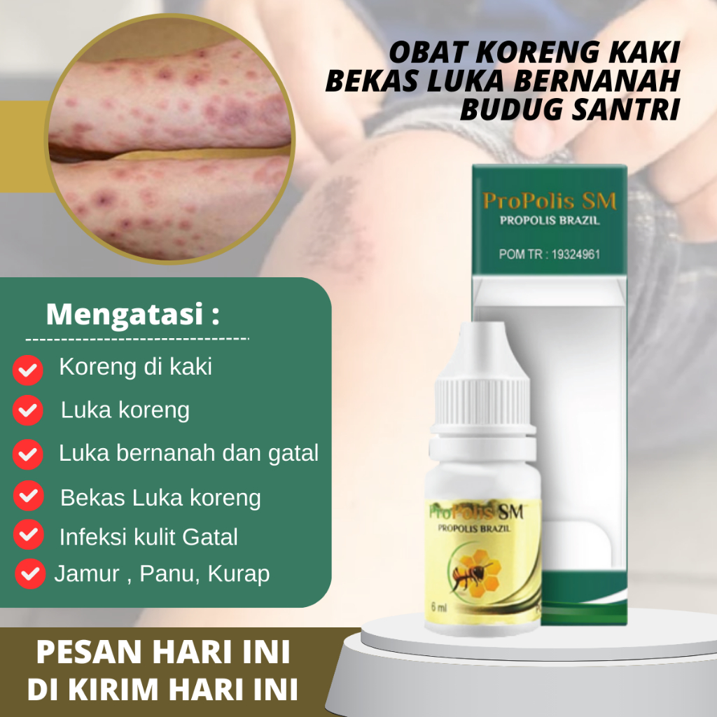 Jual Obat Koreng di kaki, Penghilang Bekas Luka hitam, Penghilang bekas ...