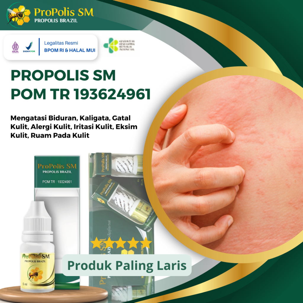 Jual Propolis SM - Obat Biduran, Kaligata, Gatal Kulit, Alergi Kulit ...