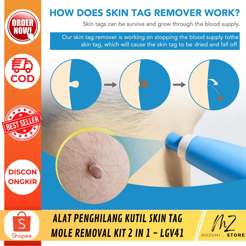 Jual Alat Penghilang Kutil Skin Tag Removal Kit 2 in 1 - LGV41 - Blue ...