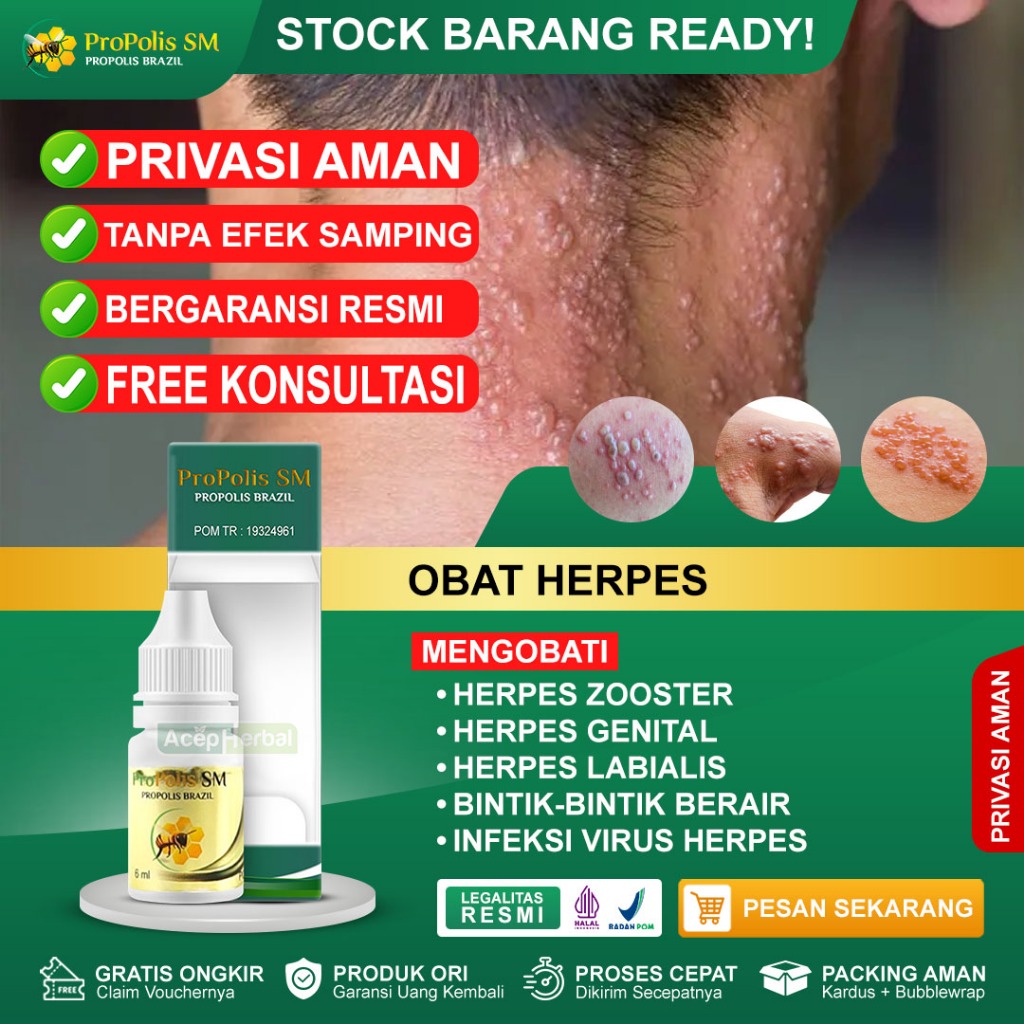 Jual Obat Herpes Infeksi Virus Herpes Bintik-bintik Berair Herpes ...