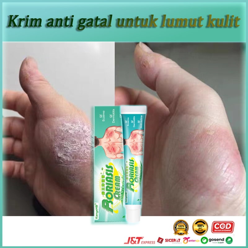 Jual salep gatal psoriasis cream salep eksim salep gatal paling ampuh ...