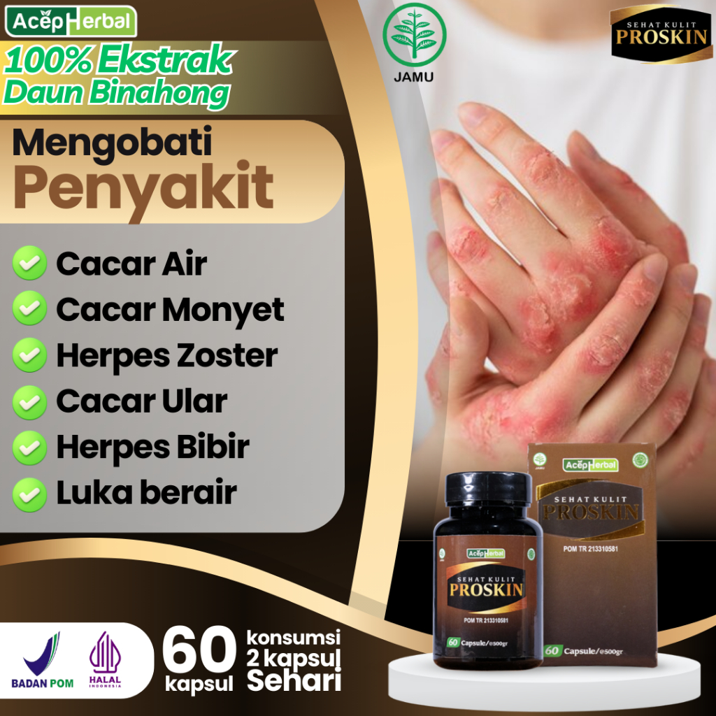Jual Obat Cacar Air, Obat Cacar Monyet, Obat Herpes Zoster, Obat Cacar ...
