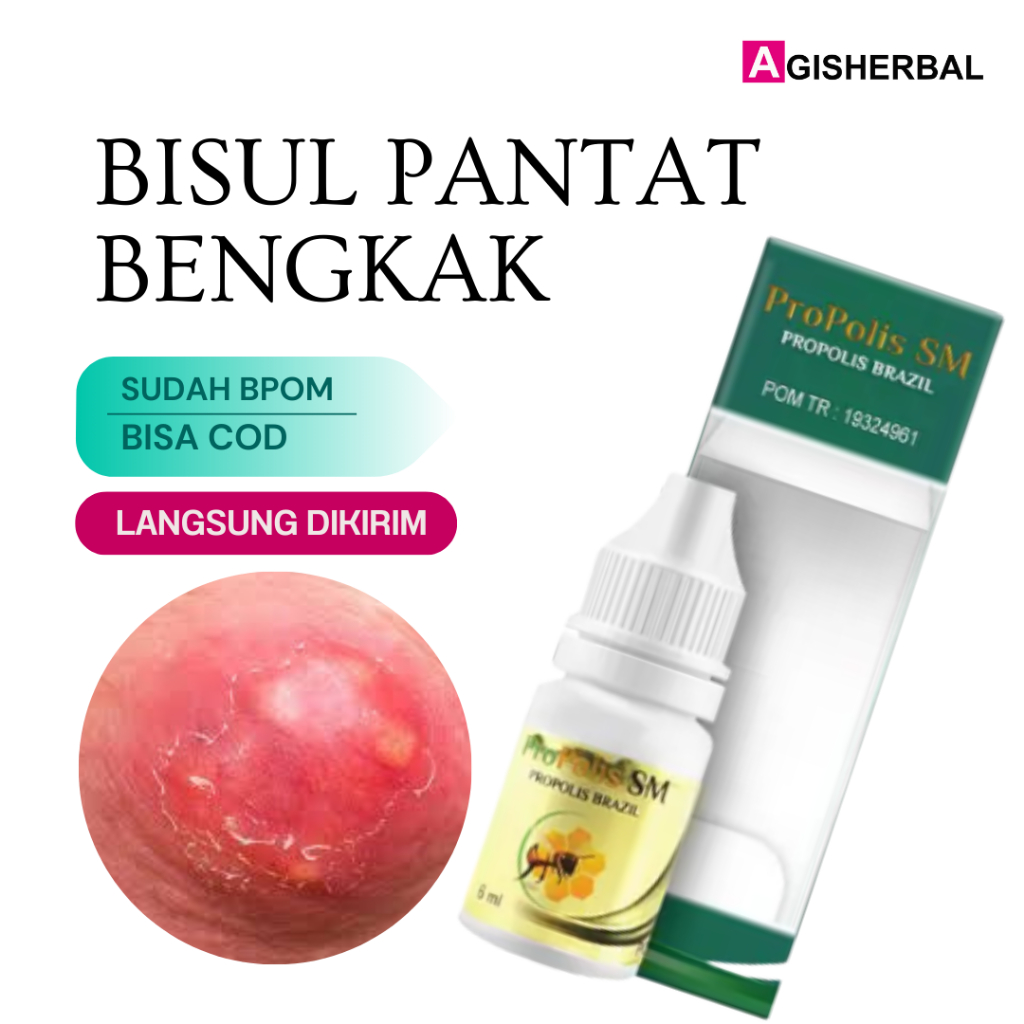 Jual Obat Bisul Di Pantat , Ketiak, Punggung Dan Tubuh Lainya Propolis ...