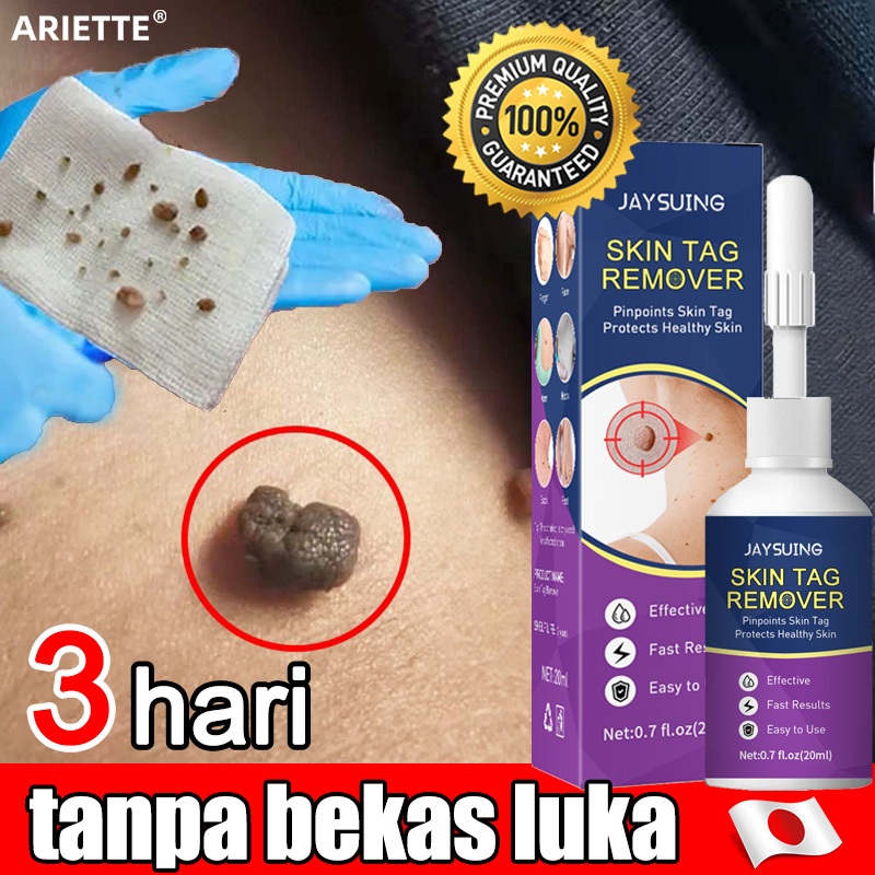 Jual Penghilang Kutil Alami Wart Remover Untuk Menghilangkan Kutil Di ...