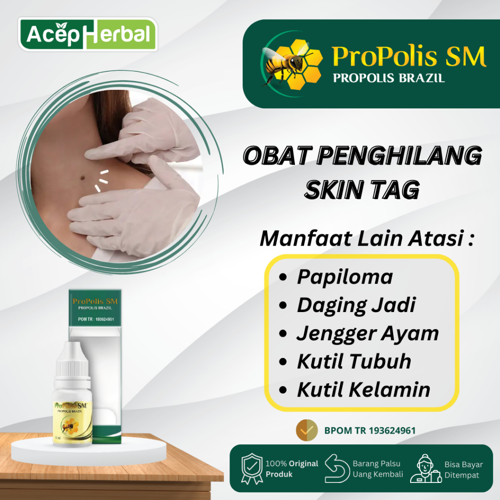 Jual Obat Penghilang Skin Tag, Daging Jadi, Papiloma, Kutil, Kutil ...