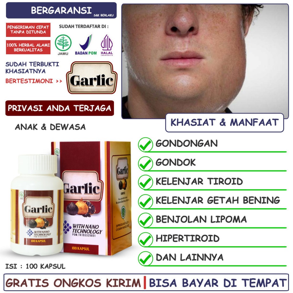Jual Obat Gondongan Anak Gondok Beracun Hipertiroid Kelenjar Tiroid Di ...