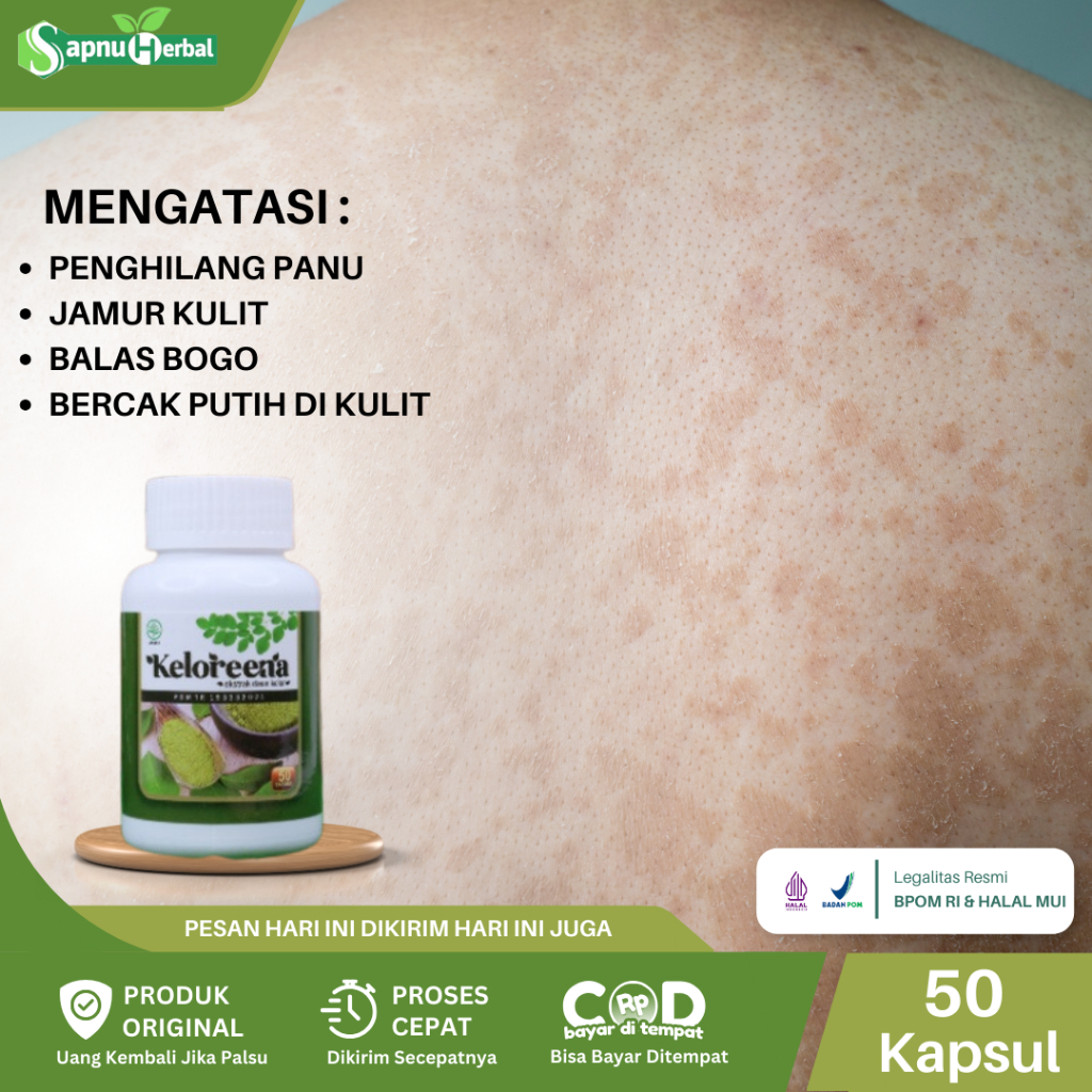 Jual Obat Panu, Jamur Kulit, Panu Anak Dan Dewasa, Panu Di Wajah ...