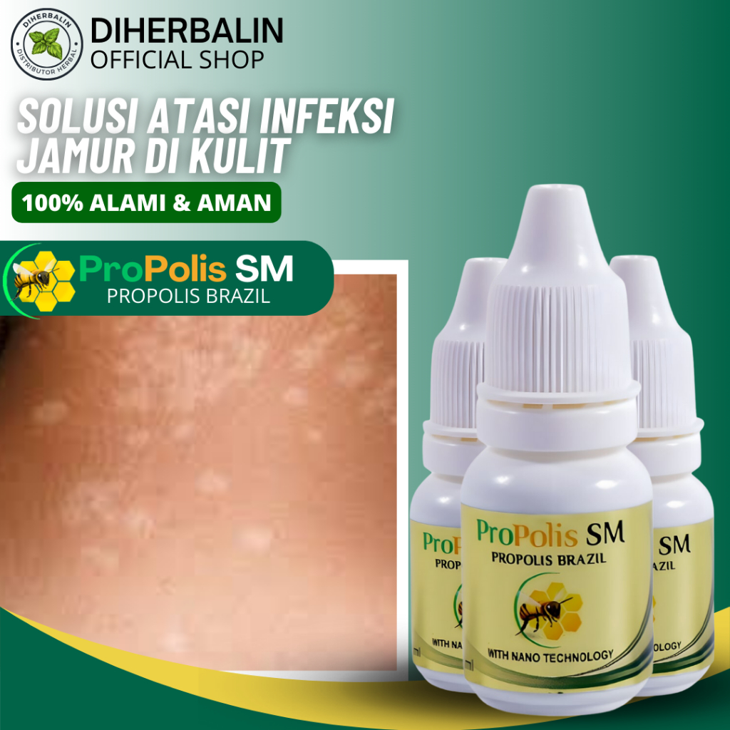 Jual Propolis SM Obat Gatal Kulit Berjamur Atasi Panu Kadas Kurap Kudis ...
