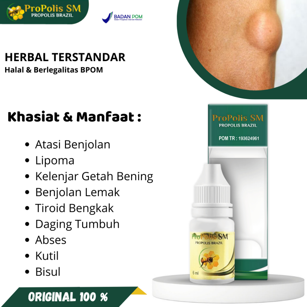Jual Obat Oles Benjolan, Lipoma, Kelenjar Getah Bening, Benjolan Lemak ...