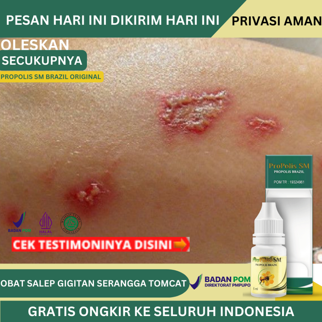 Jual Obat Gigitan Serangga Tomcat, Gatal Karena Gigitan Tomcat, Obat ...
