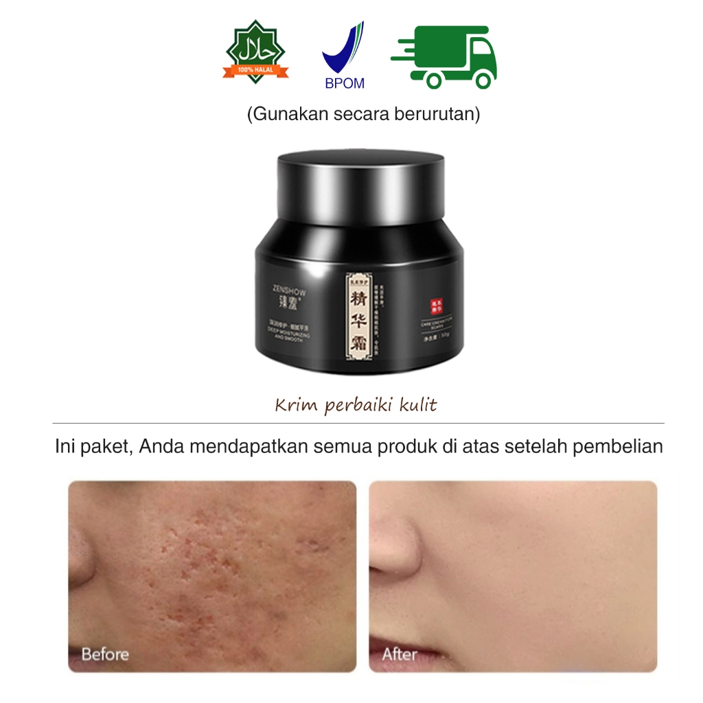 Jual Cream Penghilang Bekas Jerawat | Bopeng,dan Flek | penghilang bekas Krim wajah | Krim Salep ...