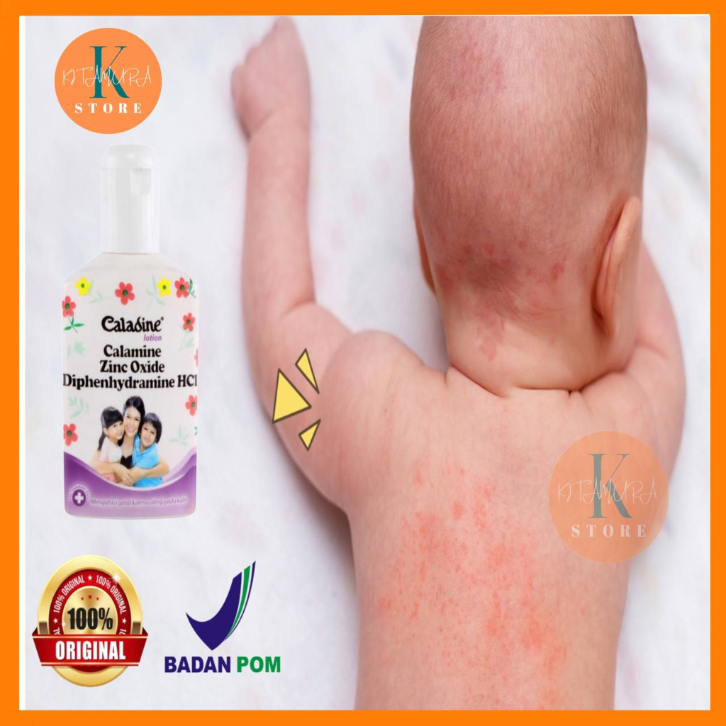 Jual Caladine lotion 60ml Obat Bedak Gatal Cair Antiseptik Alergi Biang ...