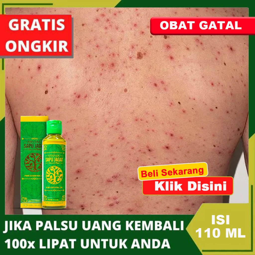 Jual Obat Gatal-Gatal Di Seluruh Badan, Alergi, Infeksi Jamur, Obat ...
