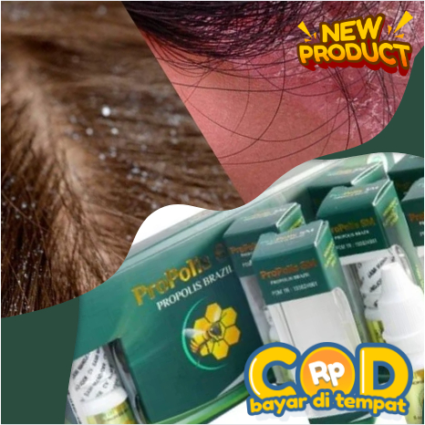 Jual Menghilangkan Gatal Gatel Ketombe Berkerak Psoriasis Penghilang Koreng di Kepala Kurap di ...