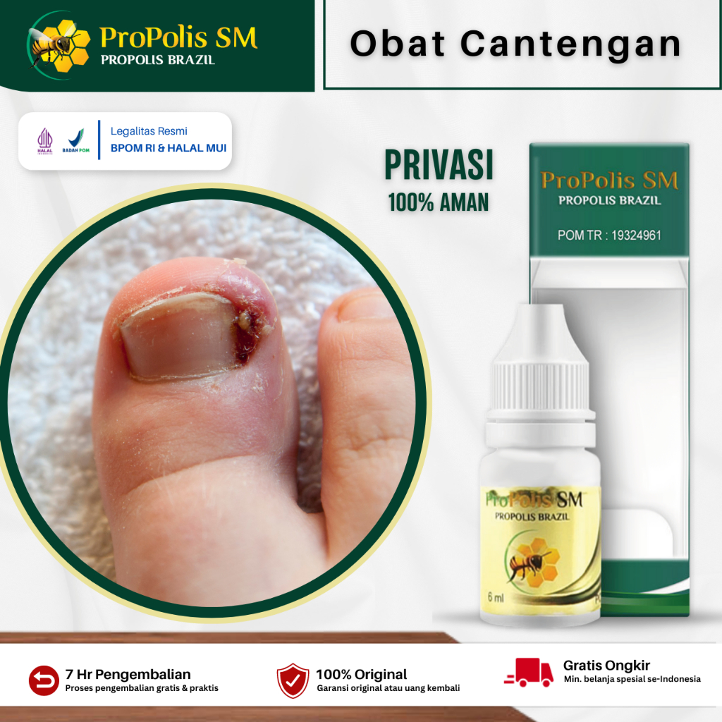Jual Obat Cantengan Jamur Kuku Jempol Kaki Bernanah Berdarah Dan Berair ...