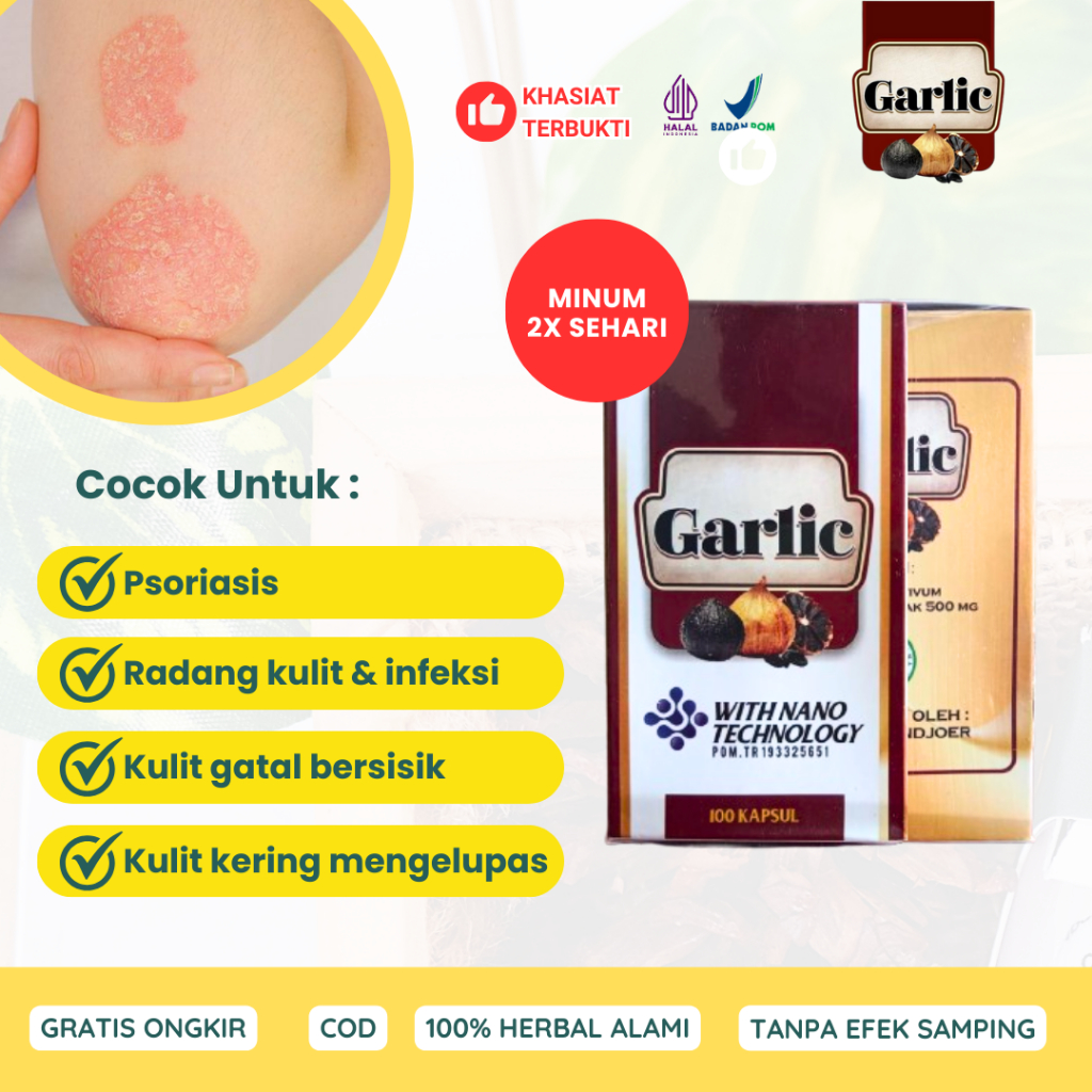 Jual Obat Psoriasis Radang Kulit Gatal Bersisik Mengelupas Berjamur ...