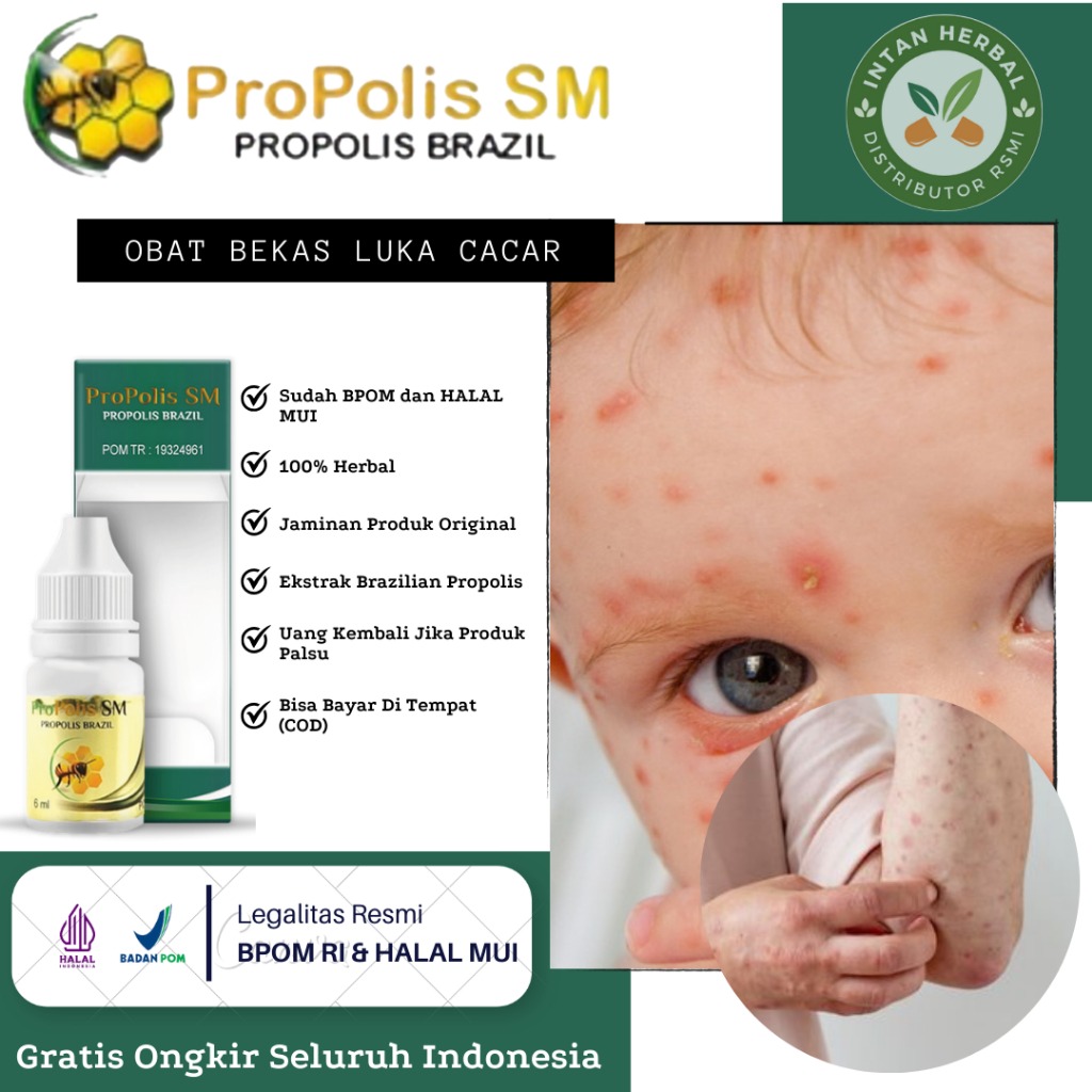 Jual Propolis SM - Obat Penghilang Bekas Luka Cacar, Cacar Air, Cacar ...