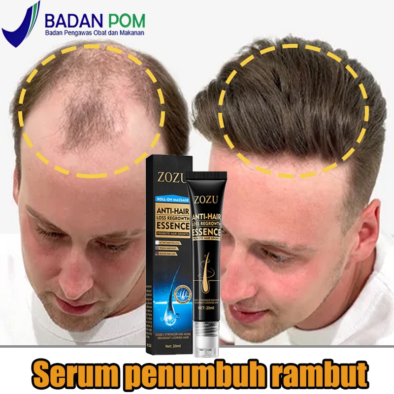 Jual Penumbuh rambut cepat Serum penumbuh rambut Penumbuh rambut botak ...
