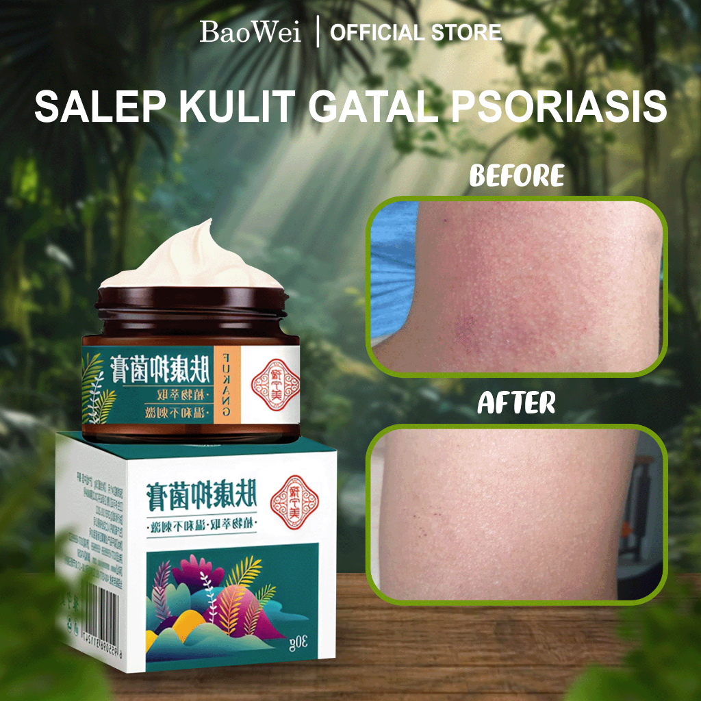 Jual [Original 100%] KRIM GATAL SALEP GATAL PSORIASIS SALEP KULIT JAMUR ...