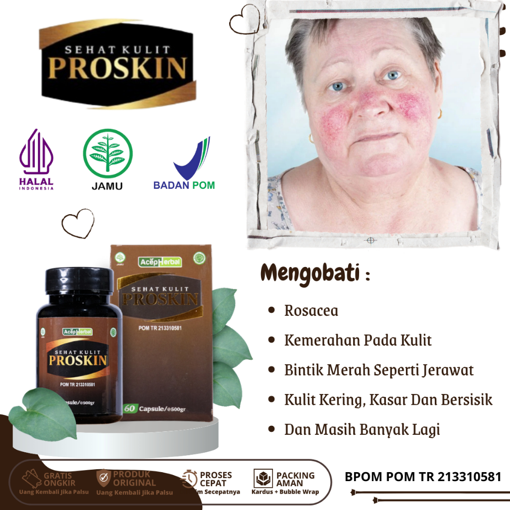 Jual Obat Rosacea Kemerahan di Kulit Wajah Bintik-Bintik Merah Seperti ...