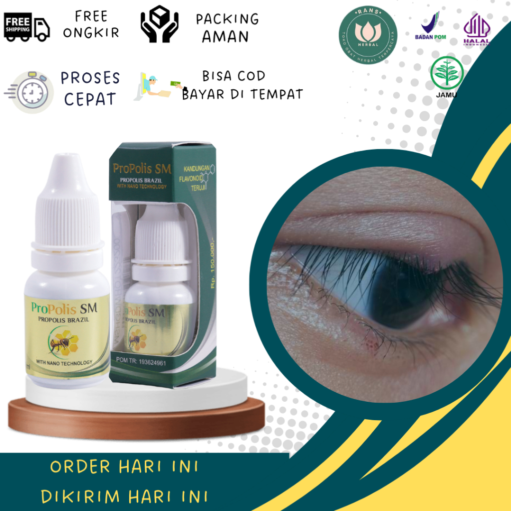 Jual Obat Herbal Mata Bintit Gatal Obat Kalazion Obat Penghilang Mata ...
