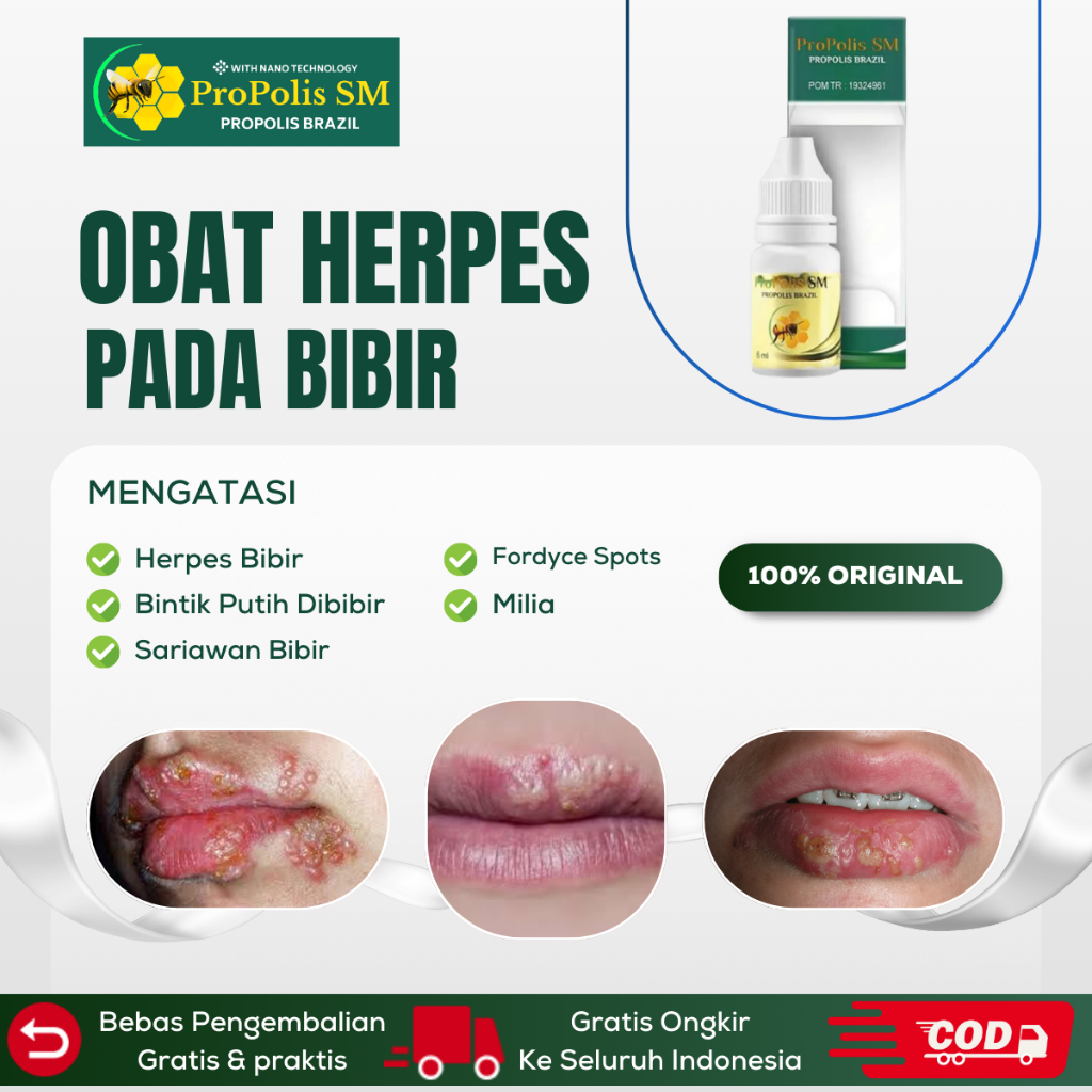 Jual Obat Herpes Bibir, Bintik Putih di Bibir, Sariawan Bibir, Luka Di ...
