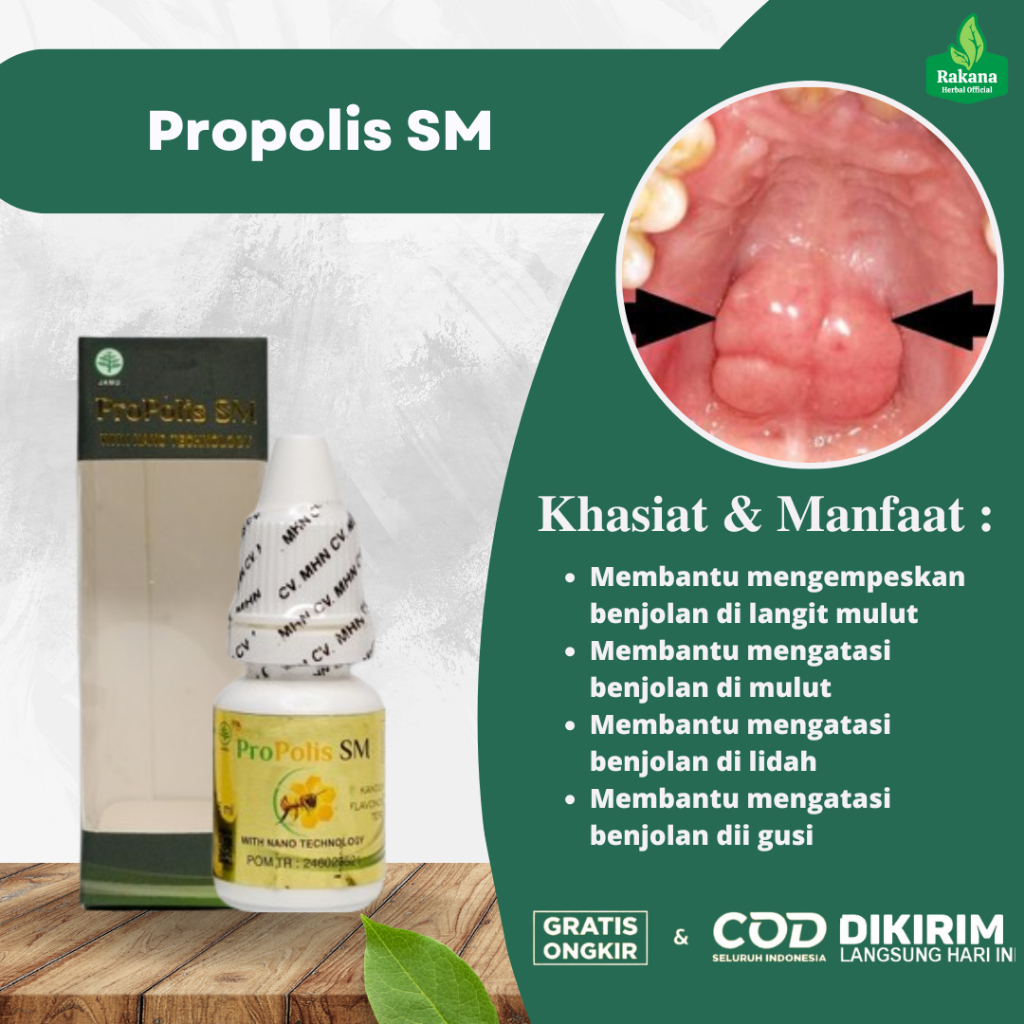 Jual Obat Benjolan Di Langit Mulut, Obat Torus Palatinus, Obat Benjolan ...