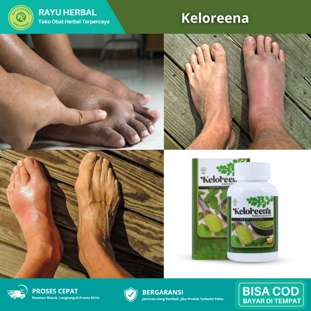 Jual Obat Kaki Bengkak, Diabetes, Asam Urat, Ginjal, Jantung, Obat ...