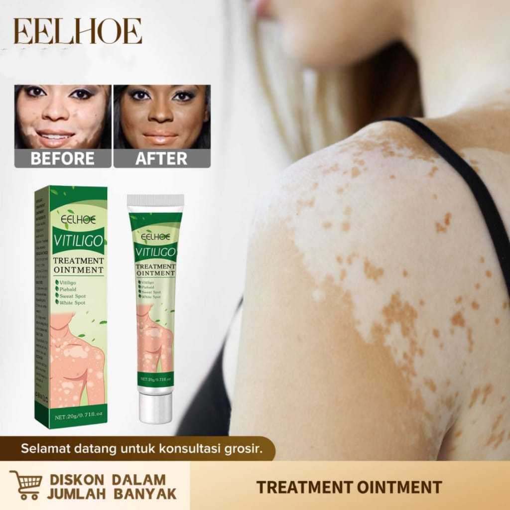 Jual [100% Asli ] Salep vitiligo, panu, biang keringat, salep panu anti ...